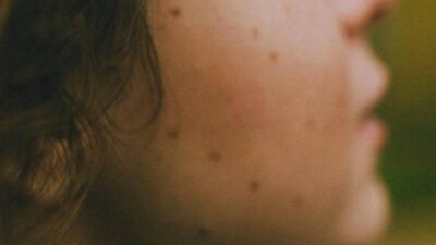 Skin Tag vs Mole: How to Tell the Difference and When to Be Concerned